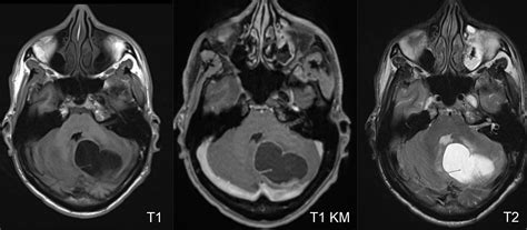 Hemangioblastoma On Mri And Angiography Rradiology