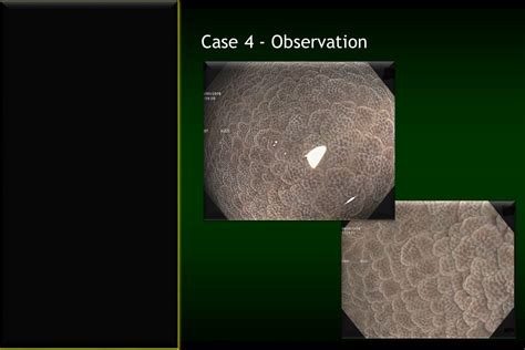 Pit Pattern Classification Colon Explorer
