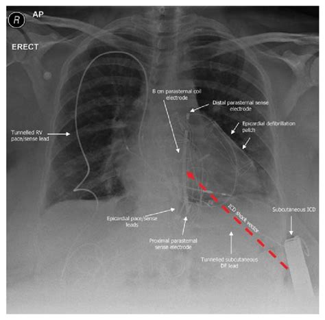 Wheelchair Positioning Icd 10 At Amanda Okane Blog