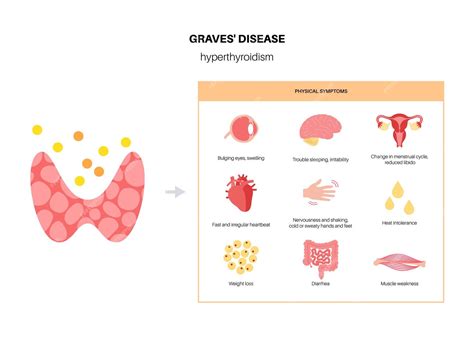 Premium Vector Graves Disease Hyperthyroidism And Immune System Disorder Overactive Thyroid Gland