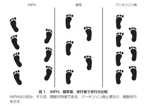 本当にパーキンソン病 神戸市中央区の訪問診療神戸ファミリークリニック