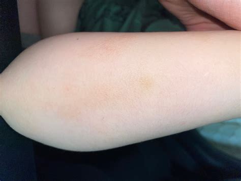 Пятна на руках у ребенка Вопрос дерматологу 03 Онлайн