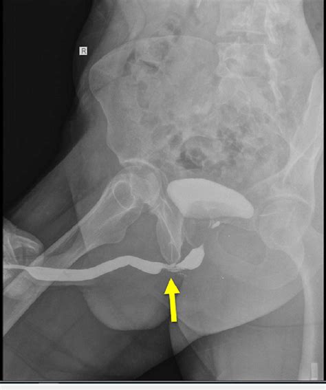 An Ascending Urethrogram Showing A 2 Cm Short Annular Stricture Segment
