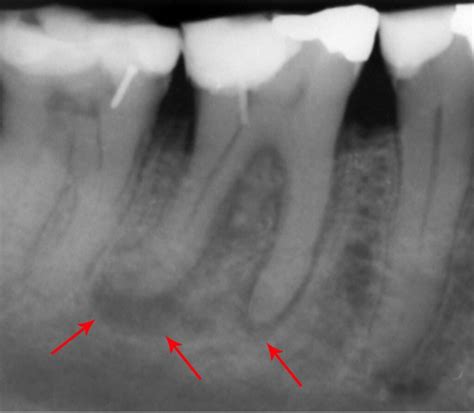 Understanding Periapical Abscesses Comprehensive Guide 2025