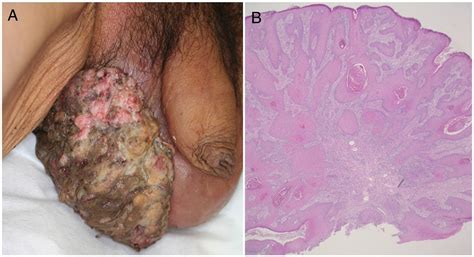 Granulocyte Colony Stimulating Factor G Csfproducing Giant Squamous