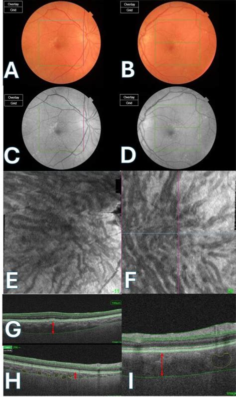 Pachychoroid Spectrum Eyewiki