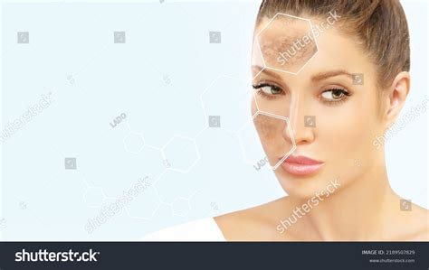 Hyperpigmentation Chloasma Melasma Age Spotspostinflammatory