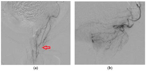 Prostatic Artery Origin Variability Five Steps To Improve Identification During Percutaneous