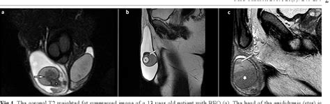 Figure 4 From Brucella And Non Brucella Epididymo Orchitis Comparison
