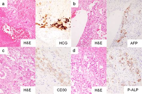 The Mediastinal Tumor Consisted Of Four Different Types Of
