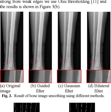 Figure 1 From Bone Extraction In X Ray Images By Analysis Of Line Fluctuations Semantic Scholar