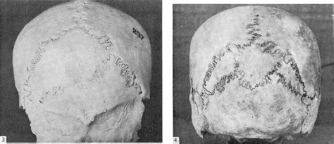 Figure 3 From Development Of Ossification Centres In The Squamous Portion Of The Occipital Bone