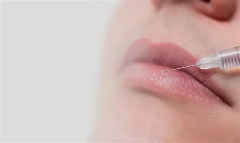 The Pros And Cons Of Lip Injections A Comprehensive Guide