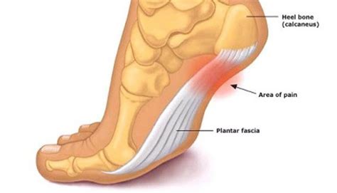 Running With Plantar Fasciitis Run Tall