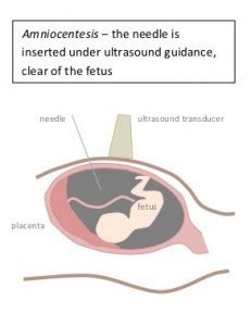 Amniocentesis Sydney Ultrasound For Women