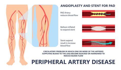 What Is An Angioplasty Procedure American Endovascular