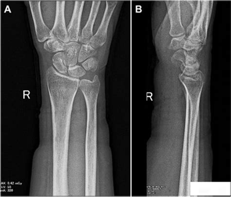 Postoperative Plain Radiograph Following Removal Of The Calcification Download Scientific
