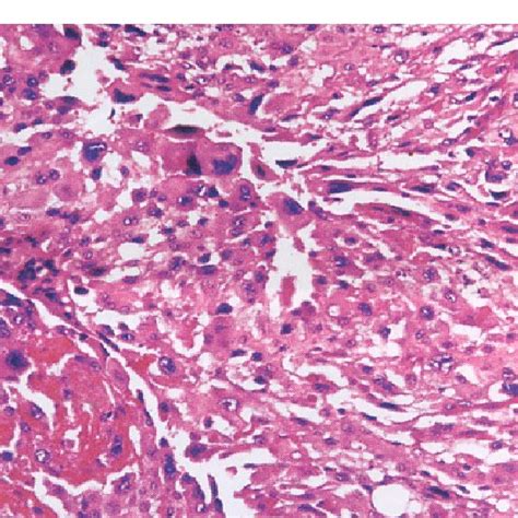 Intermediate Trophoblasts Of A Pstt Courtesy Dr U Honemeyer Download Scientific Diagram