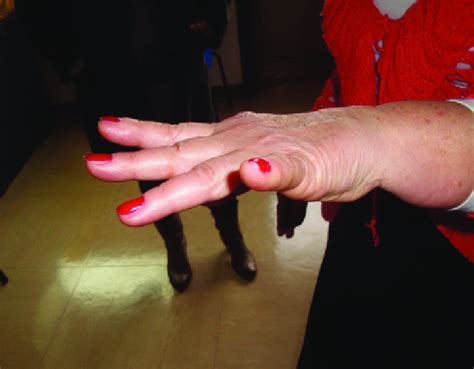 Twenty Six Months After Orif Download Scientific Diagram