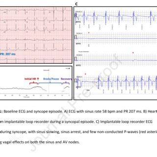 Implantable Loop Recorder Episodes A Implantable Loop Recorder Heart Download Scientific