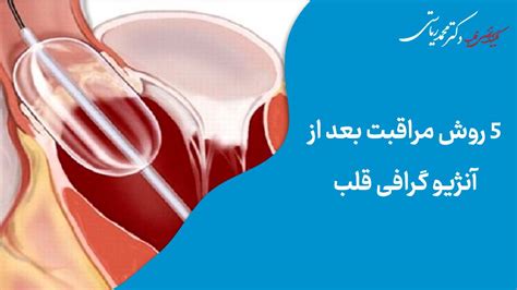 5 روش مراقبت بعد از آنژیو گرافی قلب دکتر ریاستی