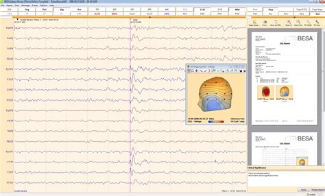 Besa® Brain Electrical Source Analysis Features Eeg Review