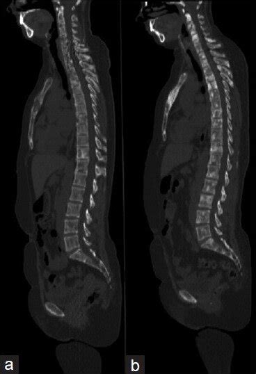 Sagittal Computed Tomography Ct Projection With Vertebral And Sternal Download Scientific