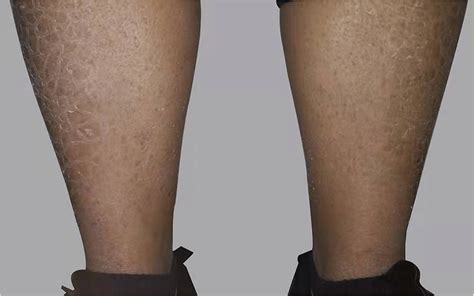 Shin Conditioning Before And After At Anthony Bohnsack Blog