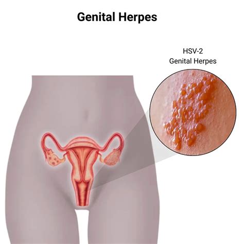 Genital Herpes Virus