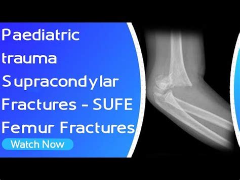 Paediatric Trauma Video MEDtube Net