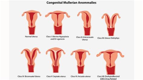 Understanding Uterine Shape Abnormalities