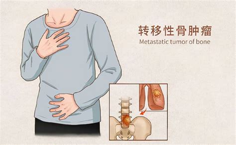 谈它色变突围中折磨林满江至死的骨病治疗真相你知道多少 骨癌 患者 医生
