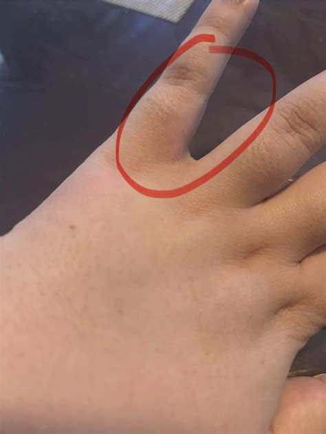 How Do I Fix This Rash R Skincareaddicts