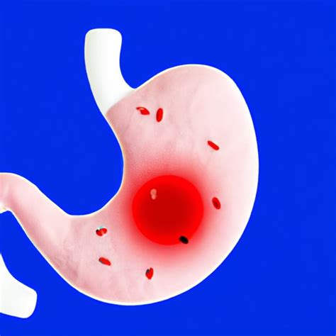 Causes Of Stomach Ulcers The Cognition Sentinel