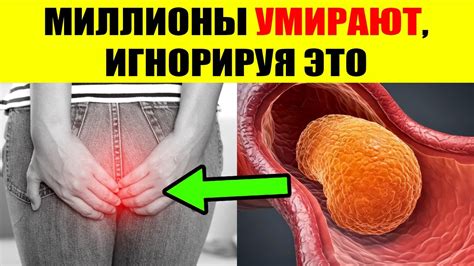 Внимание 10 Тихих Симптомов Рака Толстой Кишки Которые Вы Игнорируете Youtube