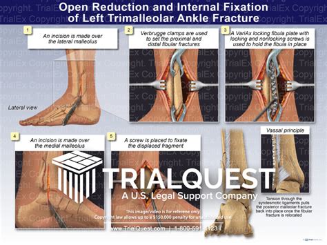 Open Reduction And Internal Fixation Of The Left Trimalleolar Ank