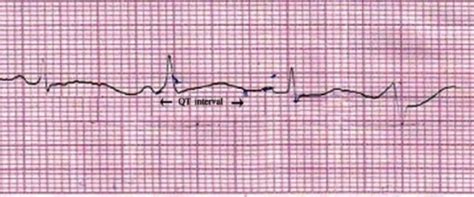 Long QT Syndrome Concise Medical Knowledge