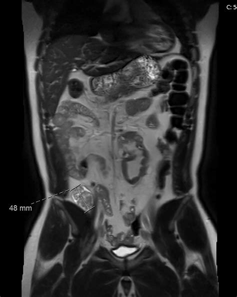 Coronal Mri Showing A Well Defined Hypervascular Mass In The Right