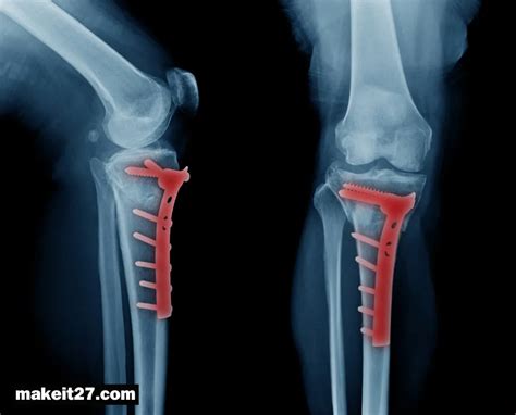 의학용어 Orif Esbl Echo Makeit27