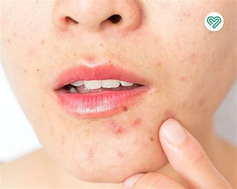 درمان جوش صورت به طرز فوری و اثربخش