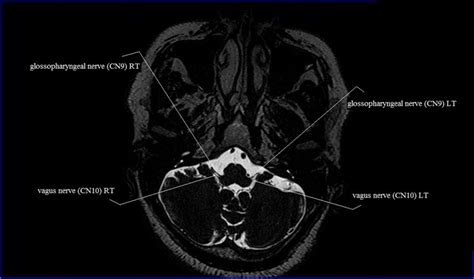 Glossopharyngeal Nerve Mri