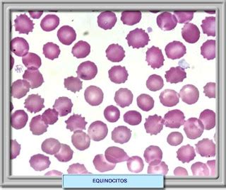 M ANORMALIDADES DEL ERITROCITO