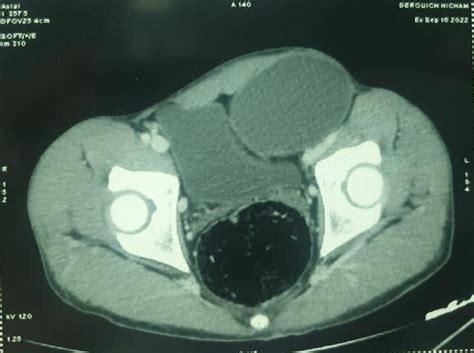 Ct Uroscan Objectifying An Abdomino Scrotal Hydrocele With Download Scientific Diagram