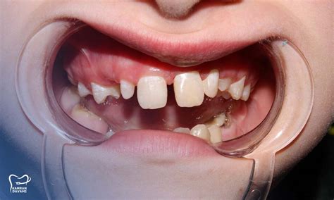 دندان نهفته کودکان؛ علل، علائم و روش درمان ویژه والدین