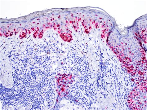 Lentigo Maligna Melanoma