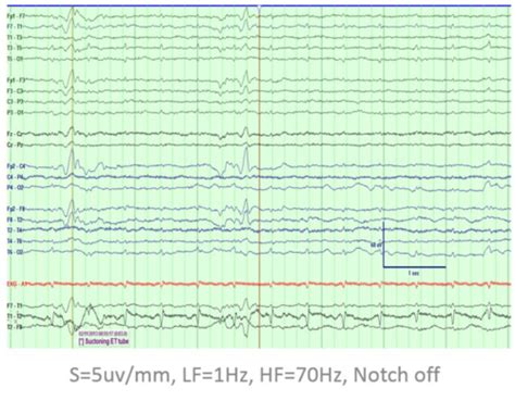 ABRET EEG EXAM PART Flashcards Quizlet