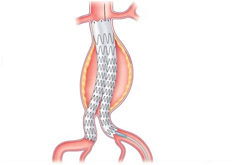 Endovascular Aortic Repair Evar