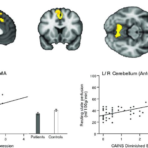 Resting State Perfusion Associated With Diminished Expression