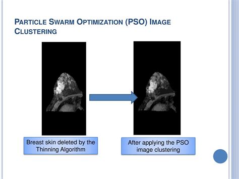 Ppt Breast Mri Tumour Segmentation Using Modified Automatic Seeded Region Growing Based On