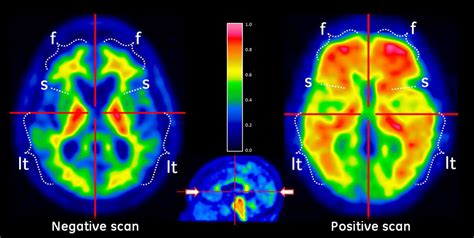 Mapping The Ptsd Brain Ge News